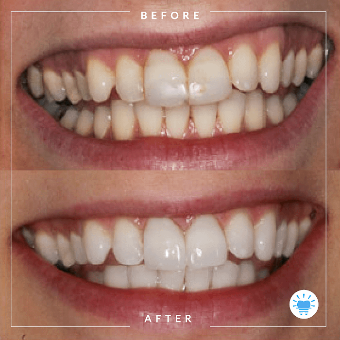 Before and After | westmountdentist.com